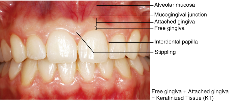 Definition of Gingival Recession and Anatomical Considerations ...