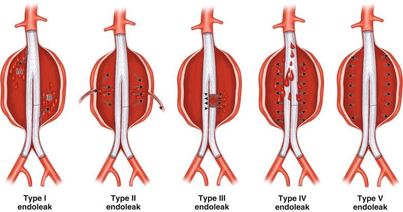 Endoleak | SpringerLink