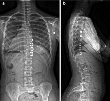 Anterior Vertebral Body Stapling for the Treatment of Idiopathic ...
