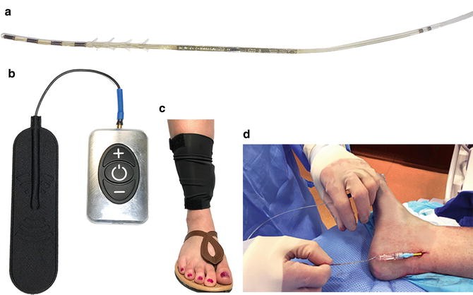 The Future of Neuromodulation | SpringerLink