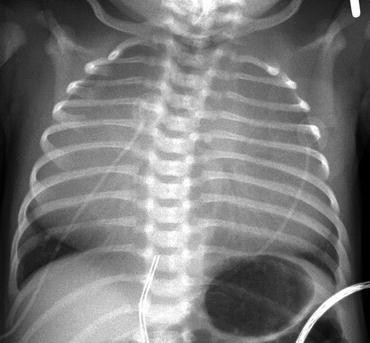 Radiographic Evaluation of the Child with Heart Disease | SpringerLink