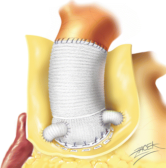 Bentall Procedure | SpringerLink