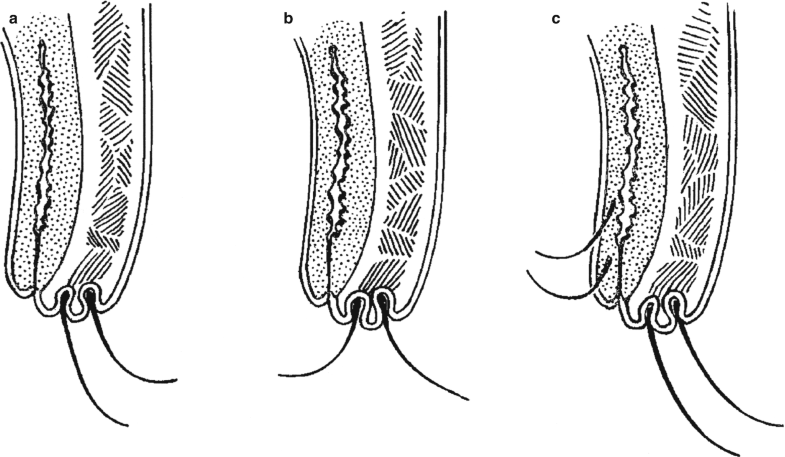 Trichiasis and Distichiasis | SpringerLink