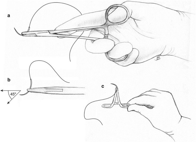 Fundamentals of Sutures, Needles, Knot Tying, and Suturing Technique ...