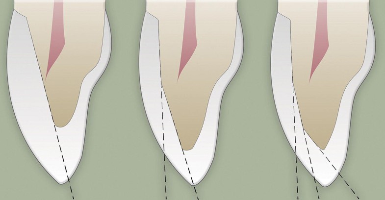 Fundamentals of Tooth Preparation | SpringerLink