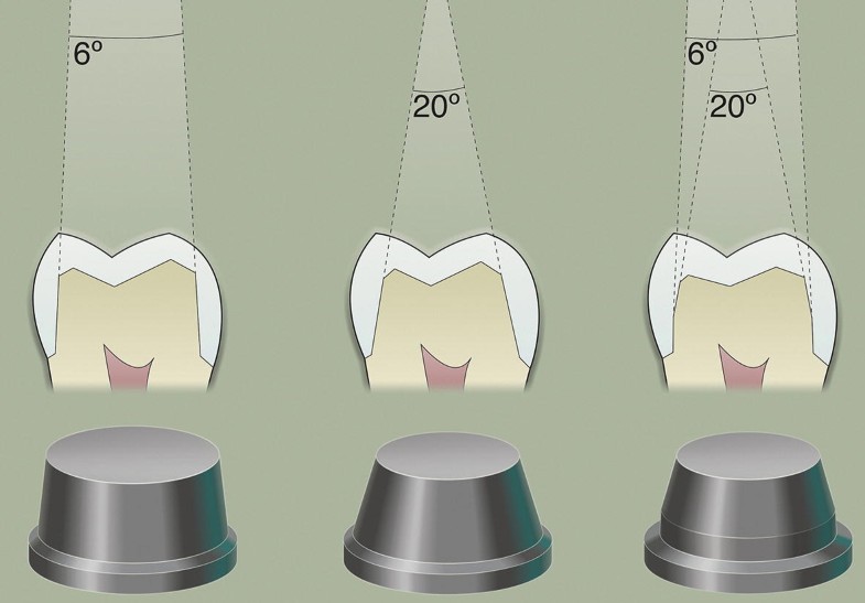 Fundamentals of Tooth Preparation | SpringerLink