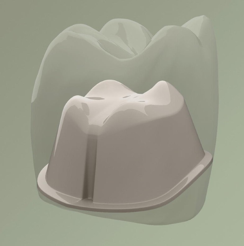 Fundamentals of Tooth Preparation | SpringerLink