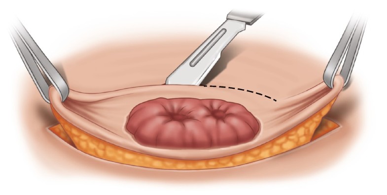 Loop Ileostomy Creation and Closure | SpringerLink