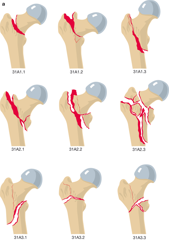 Per- und subtrochantere Femurfrakturen | SpringerLink