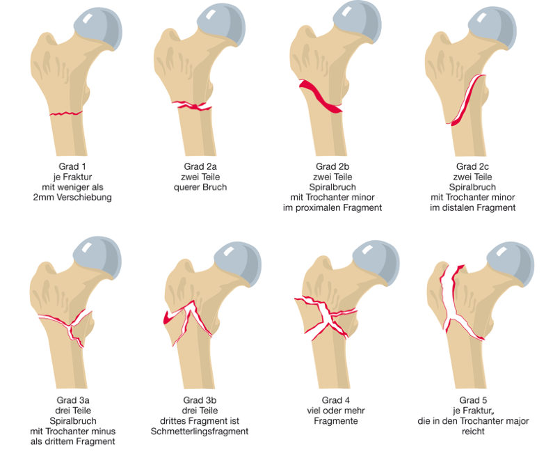 Per- und subtrochantere Femurfrakturen | SpringerLink