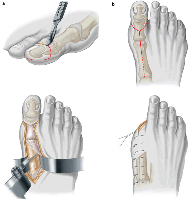 Komplextrauma und plastische Rekonstruktion | SpringerLink
