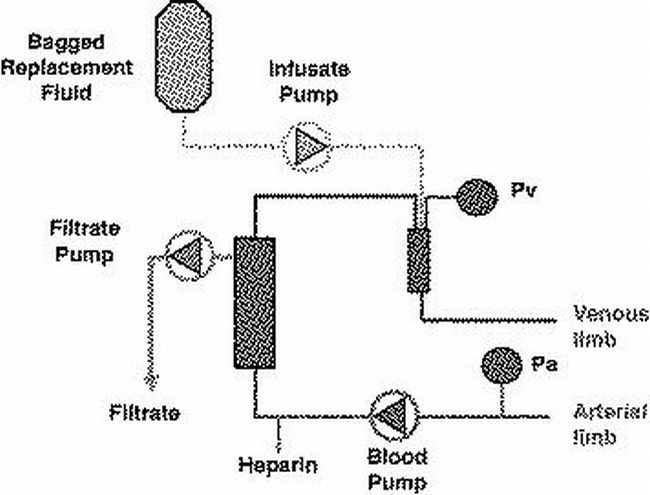Principles of Extracorporeal Therapy: Haemodialysis, Haemofiltration ...