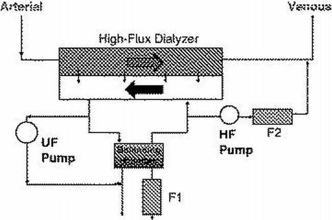 Principles of Extracorporeal Therapy: Haemodialysis, Haemofiltration ...