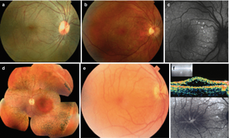 Enhanced S-Cone Syndrome | SpringerLink
