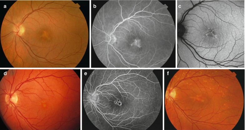 Retinal Dystrophies Associated with the PRPH2 Gene | SpringerLink