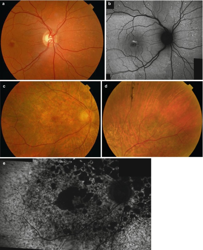Retinal Dystrophies Associated with the PRPH2 Gene | SpringerLink
