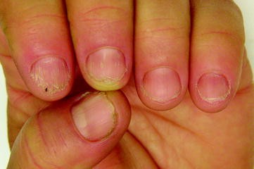 Nail Thinning | SpringerLink