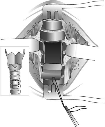 Tracheotomy | SpringerLink