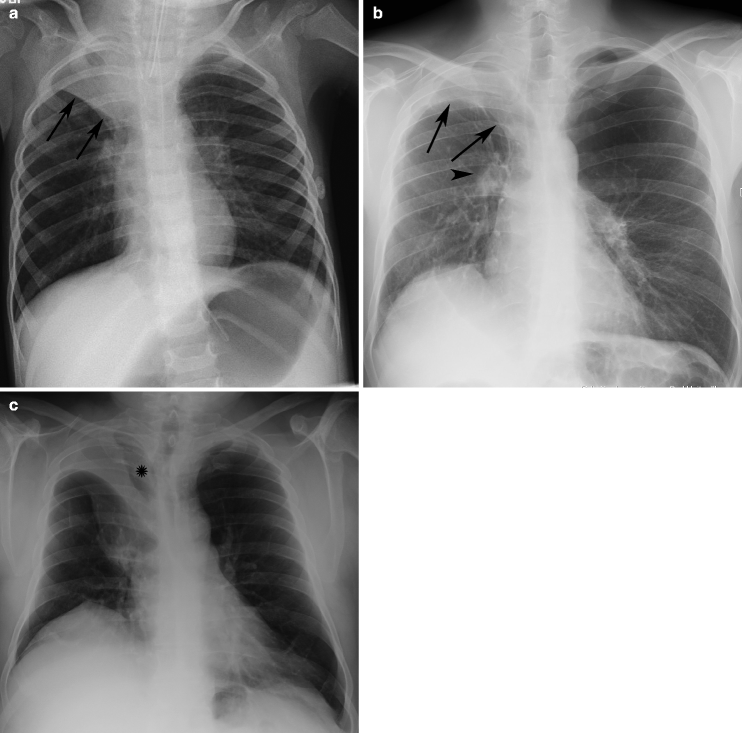 Atelectasis | SpringerLink