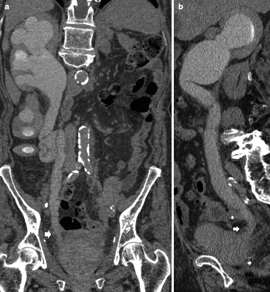 Obstructive Uropathy, Pyonephrosis, and Reflux Nephropathy in Adults ...