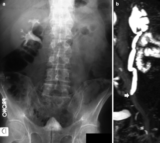 Obstructive Uropathy, Pyonephrosis, and Reflux Nephropathy in Adults ...
