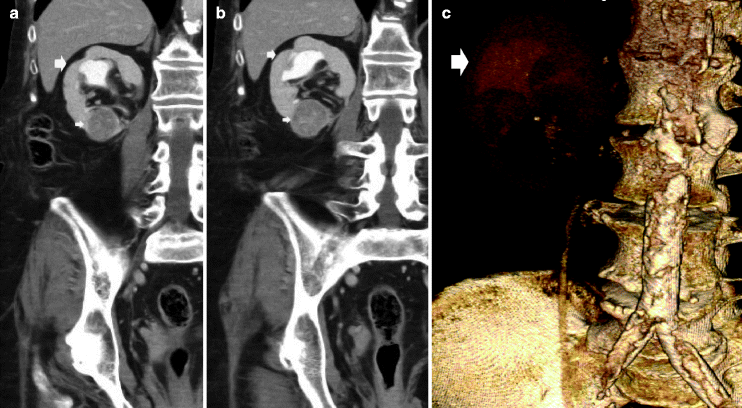 Obstructive Uropathy, Pyonephrosis, and Reflux Nephropathy in Adults ...