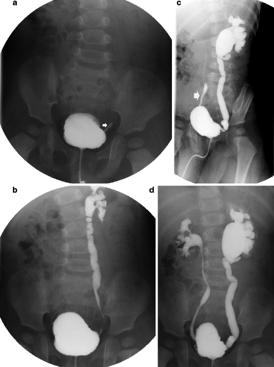 Obstructive Uropathy, Pyonephrosis, and Reflux Nephropathy in Adults ...