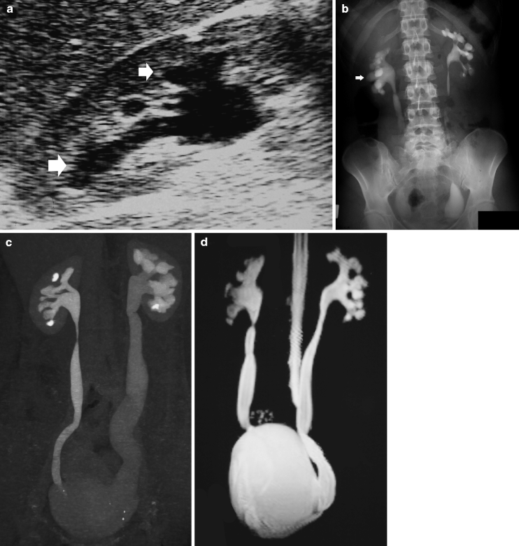 Obstructive Uropathy, Pyonephrosis, and Reflux Nephropathy in Adults ...