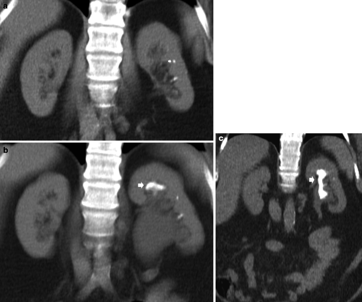 Nephrocalcinosis and Nephrolithiasis | SpringerLink