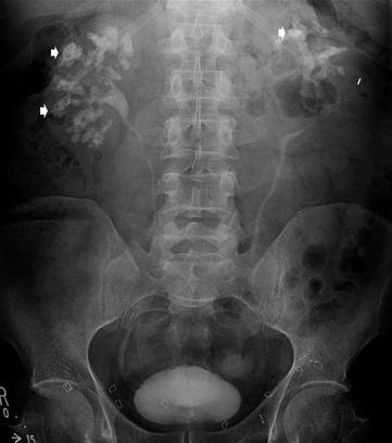 Nephrocalcinosis and Nephrolithiasis | SpringerLink