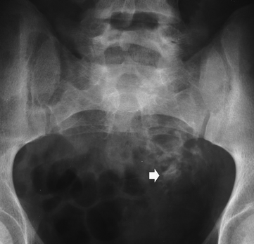 Nephrocalcinosis and Nephrolithiasis | SpringerLink