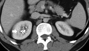 Nephrocalcinosis and Nephrolithiasis | SpringerLink