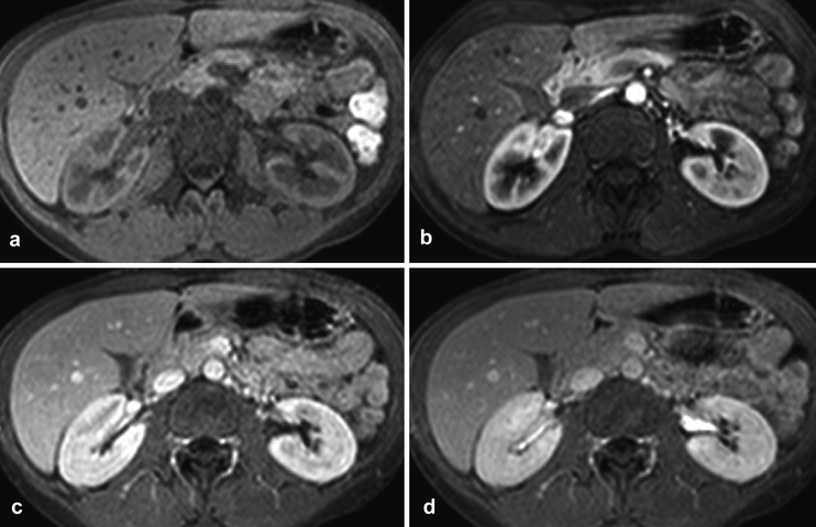 Normal Radiological Anatomy and Anatomical Variants of the Kidney ...