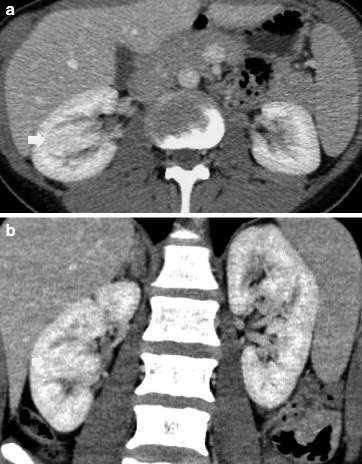 Normal Radiological Anatomy and Anatomical Variants of the Kidney ...