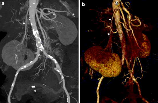 Normal Radiological Anatomy and Anatomical Variants of the Kidney ...