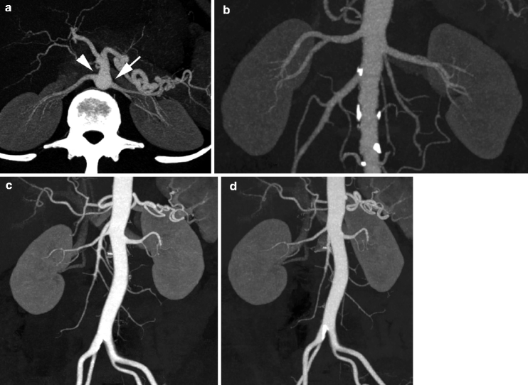 Normal Radiological Anatomy and Anatomical Variants of the Kidney ...