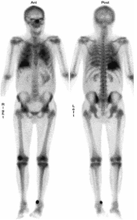 Bone Scintigraphy: Patterns, Variants, Limitations and Artefacts ...