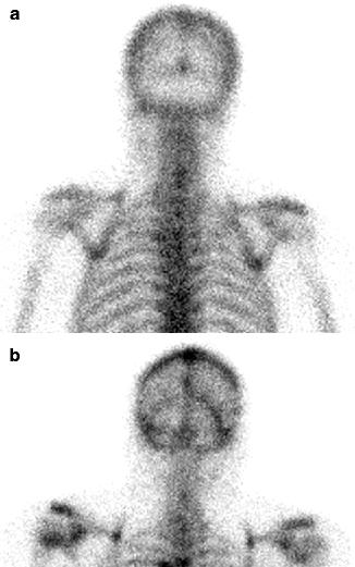 Bone Scintigraphy: Patterns, Variants, Limitations and Artefacts ...