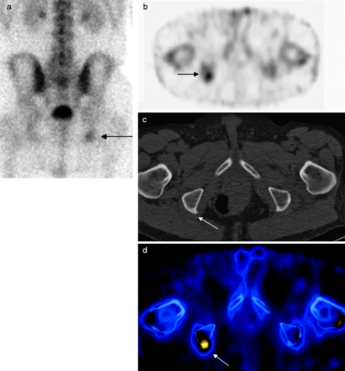 Bone Scintigraphy: Patterns, Variants, Limitations and Artefacts ...