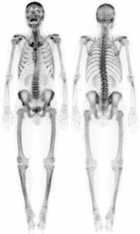Bone Scintigraphy: Patterns, Variants, Limitations and Artefacts ...