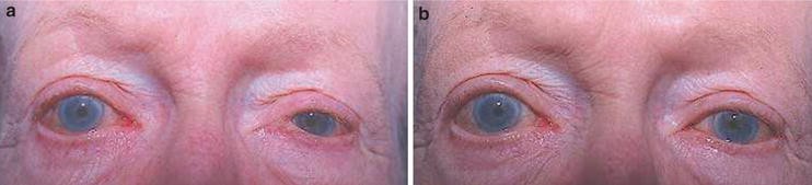 Minimally Invasive Oculoplastic Surgery | SpringerLink
