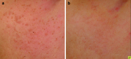 Pigmentation and Hypopigmentation: Benign Pigmented Lesions | SpringerLink