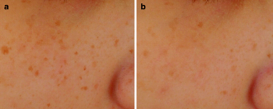 Pigmentation and Hypopigmentation: Benign Pigmented Lesions | SpringerLink