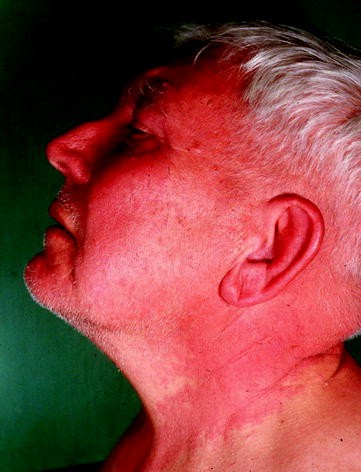 Phototoxic and Photoallergic Reactions | SpringerLink