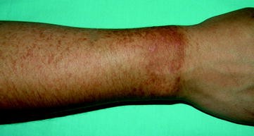 Phototoxic and Photoallergic Reactions | SpringerLink