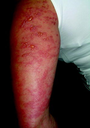 Phototoxic and Photoallergic Reactions | SpringerLink