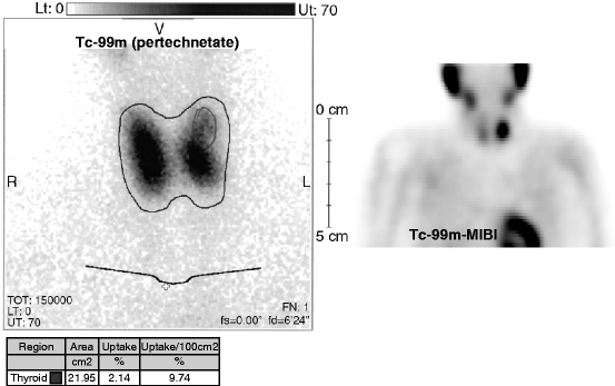 Tc-99m-MIBI for Thyroid Imaging | SpringerLink