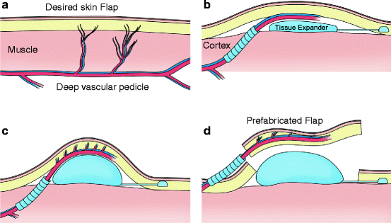 Prefabricated and Prelaminated Flaps | SpringerLink