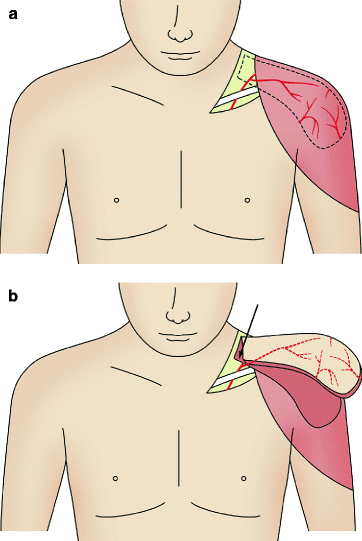 Supraclavicular Flap | SpringerLink