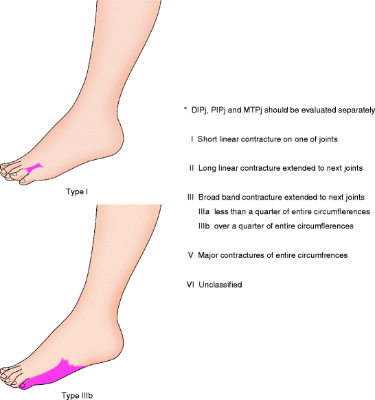 Diagnosis, Assessment, and Classification of Scar Contractures ...